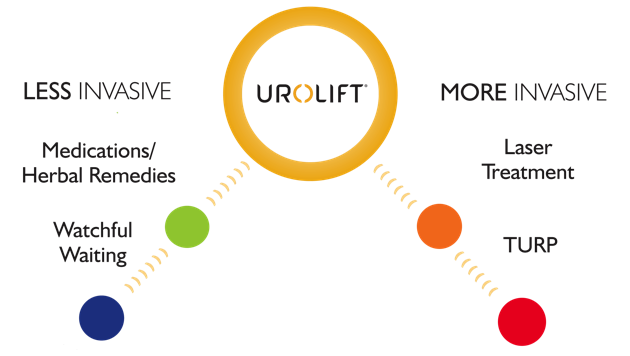 UroLift® | Mens BPH Treatment for Enlarged Prostate